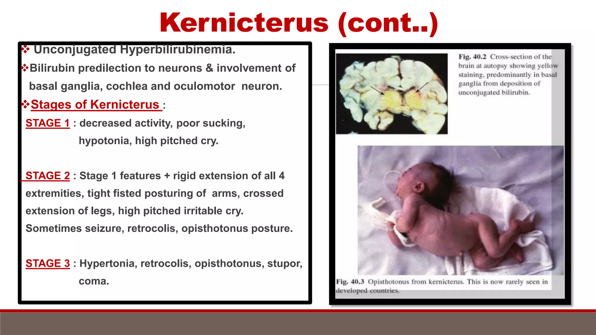 Neonatal jaundice final