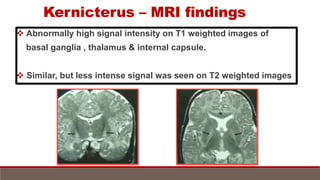 Kernicterus Mri