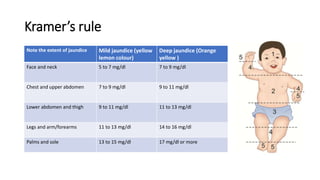 NEONATAL JAUNDICE 2.pptx