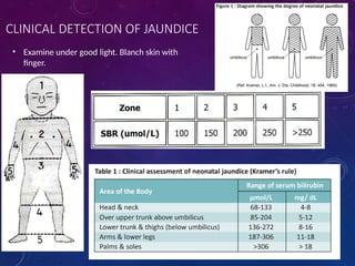 management of NEONATAL JAUNDICE in primary care.ppt