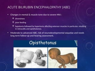 management of NEONATAL JAUNDICE in primary care.ppt