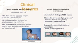 Neonatal jaundice by Raghad FM R2 Latest AAP Guideline 2022 | PPTX
