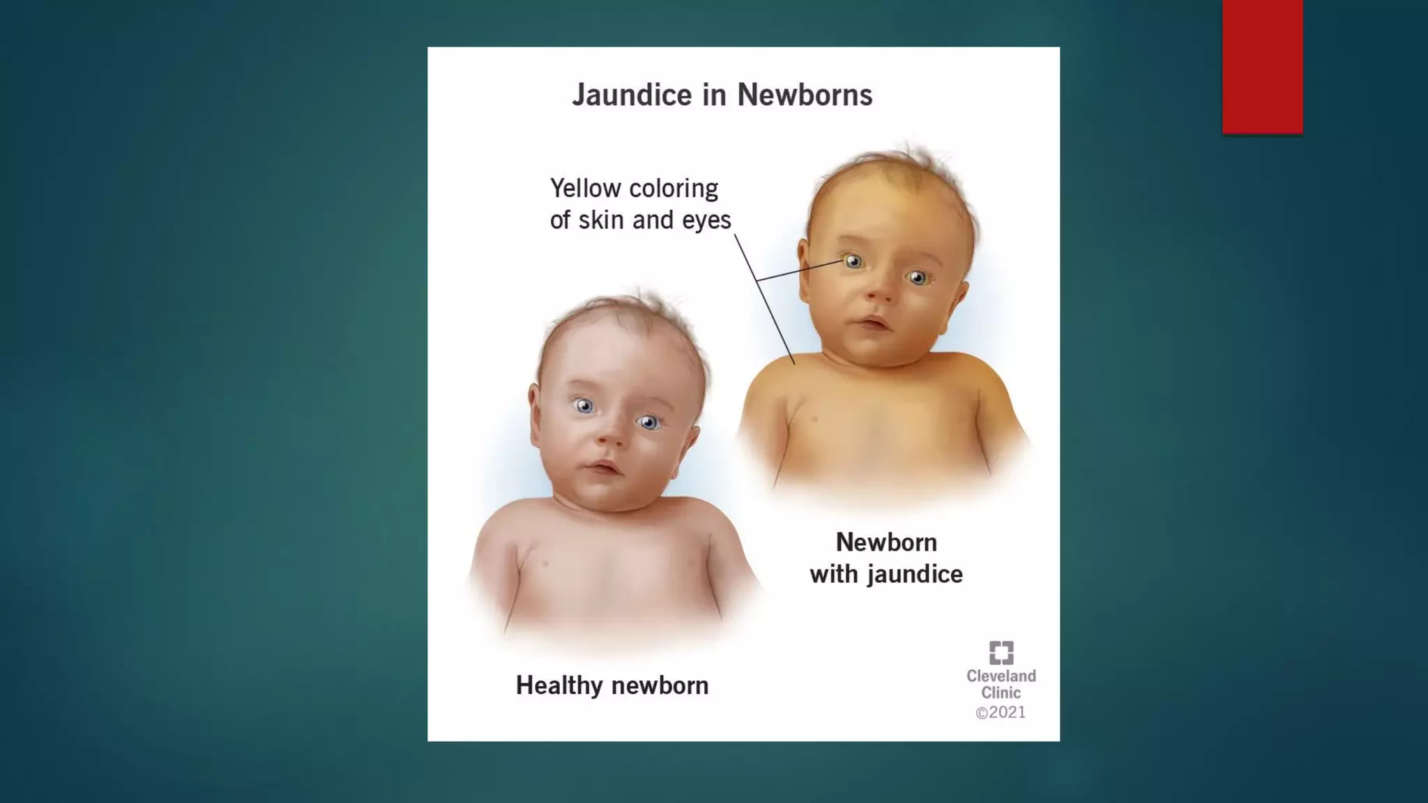 NEONATAL JAUNDICE PPT.pdf