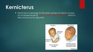 Neonatal Jaundice Jaundice Neonates And Problems Pptx