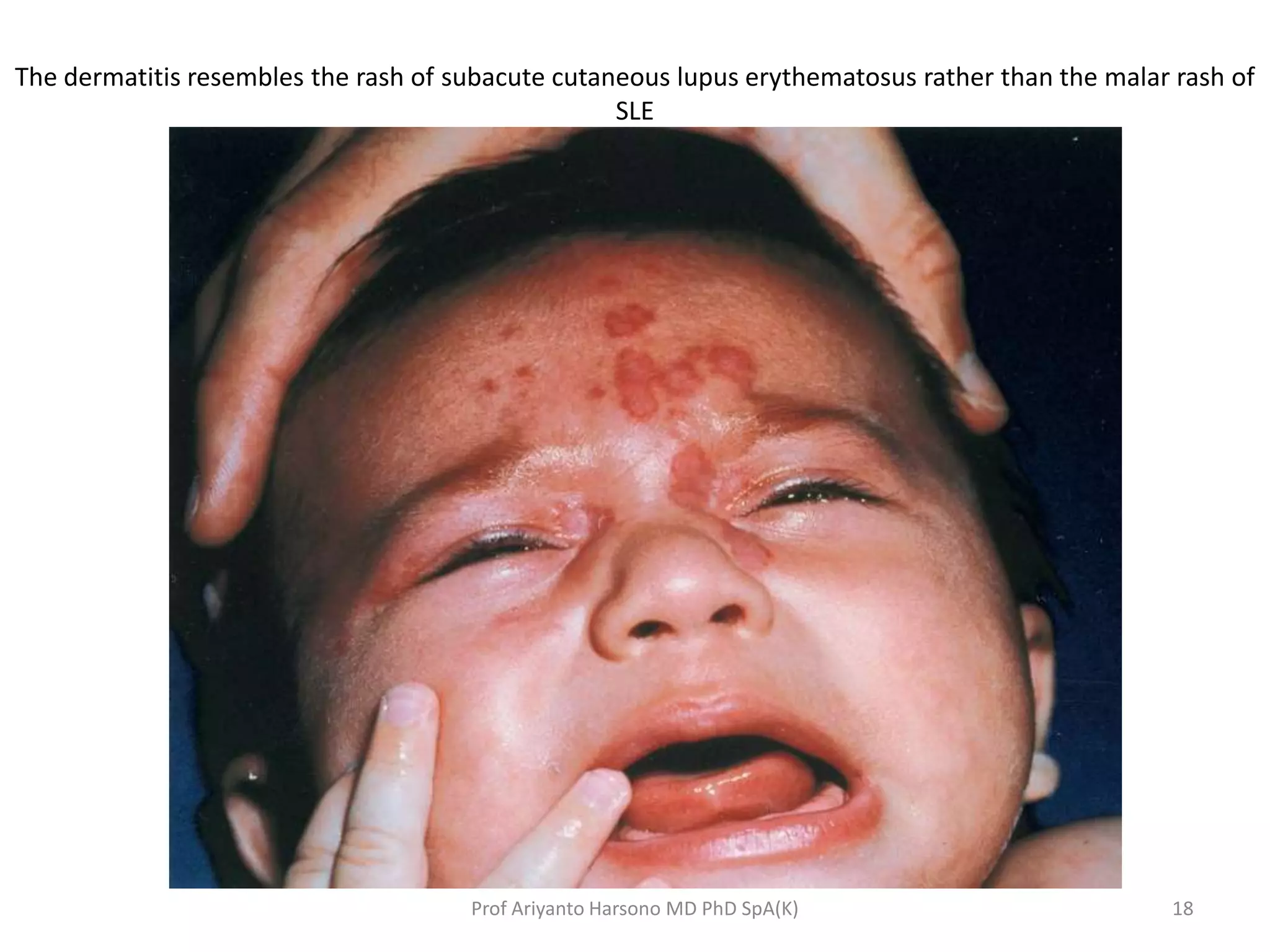 Neonatal lupus erythematosus | PPTX