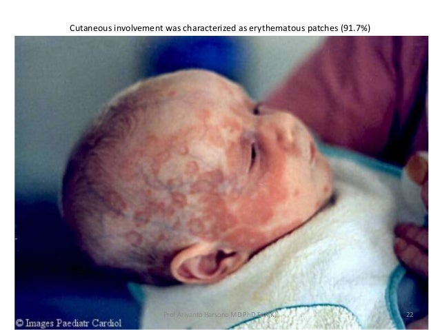 Neonatal lupus erythematosus