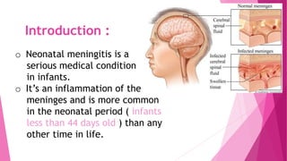 Neonatal Meningtis | PPTX