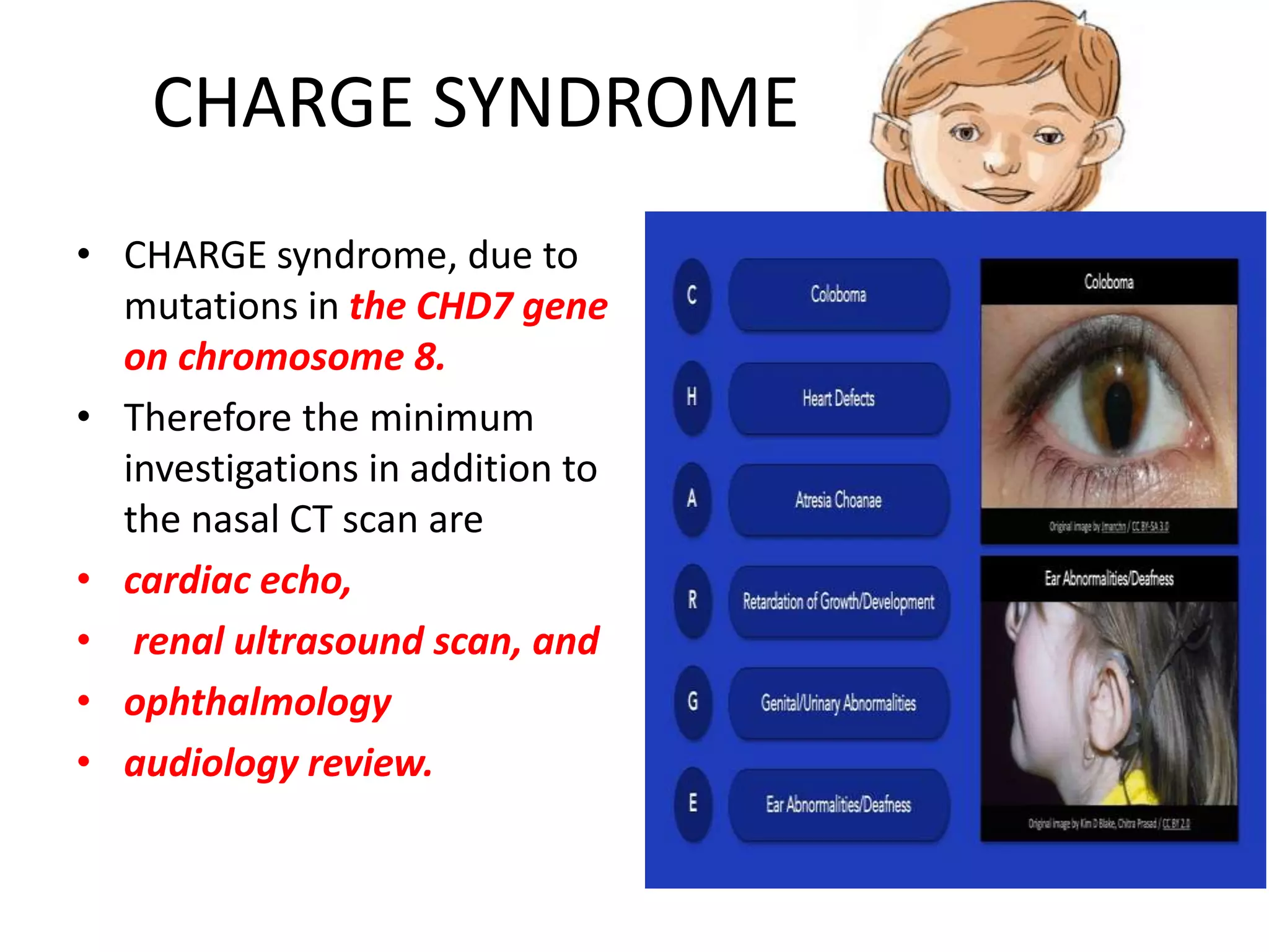Neonatal nasal obstruction final | PPTX