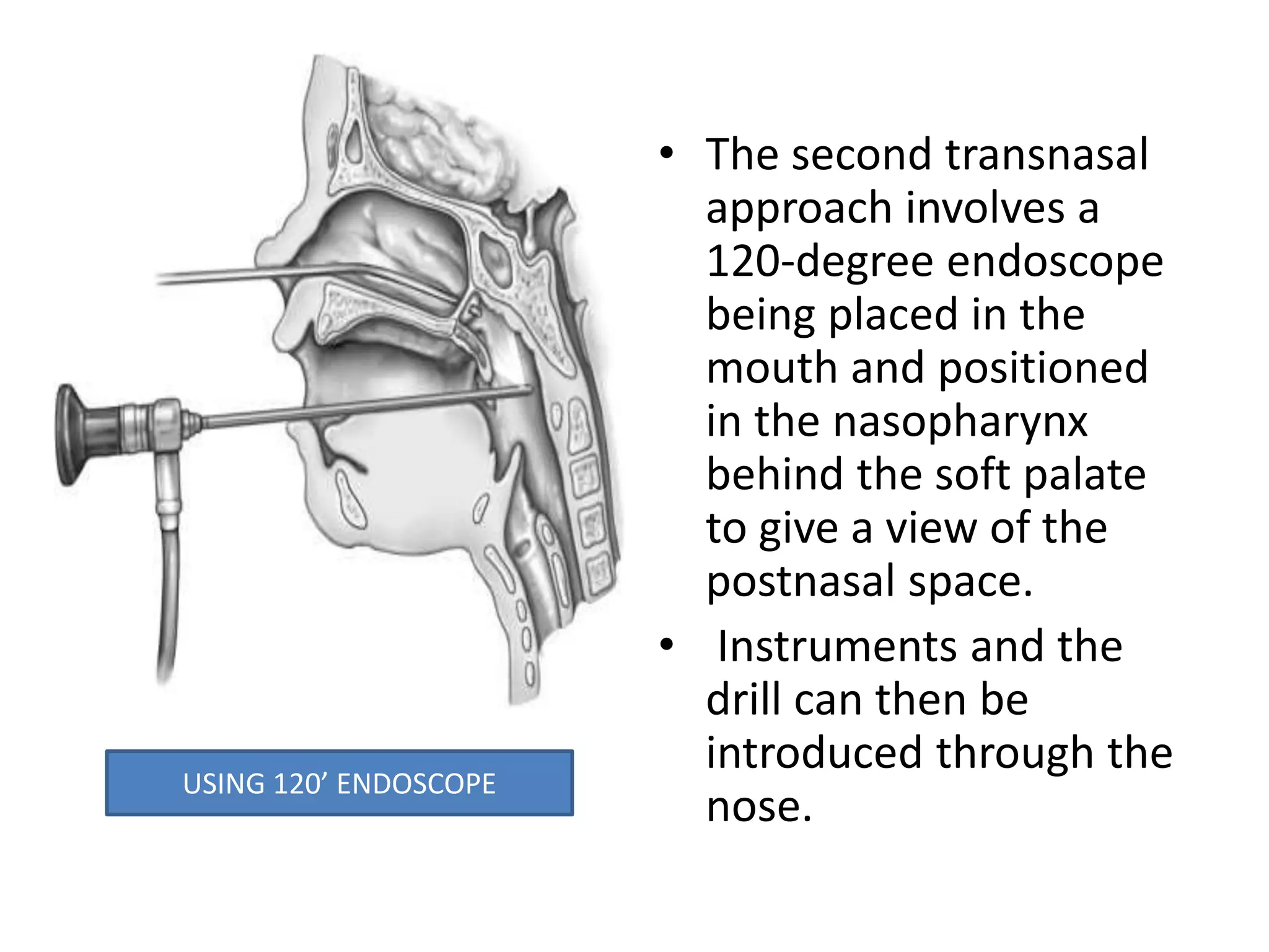 Neonatal nasal obstruction final | PPTX