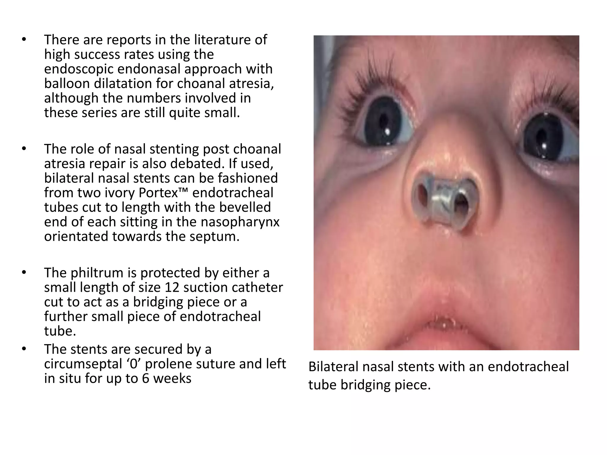 Neonatal nasal obstruction final | PPTX