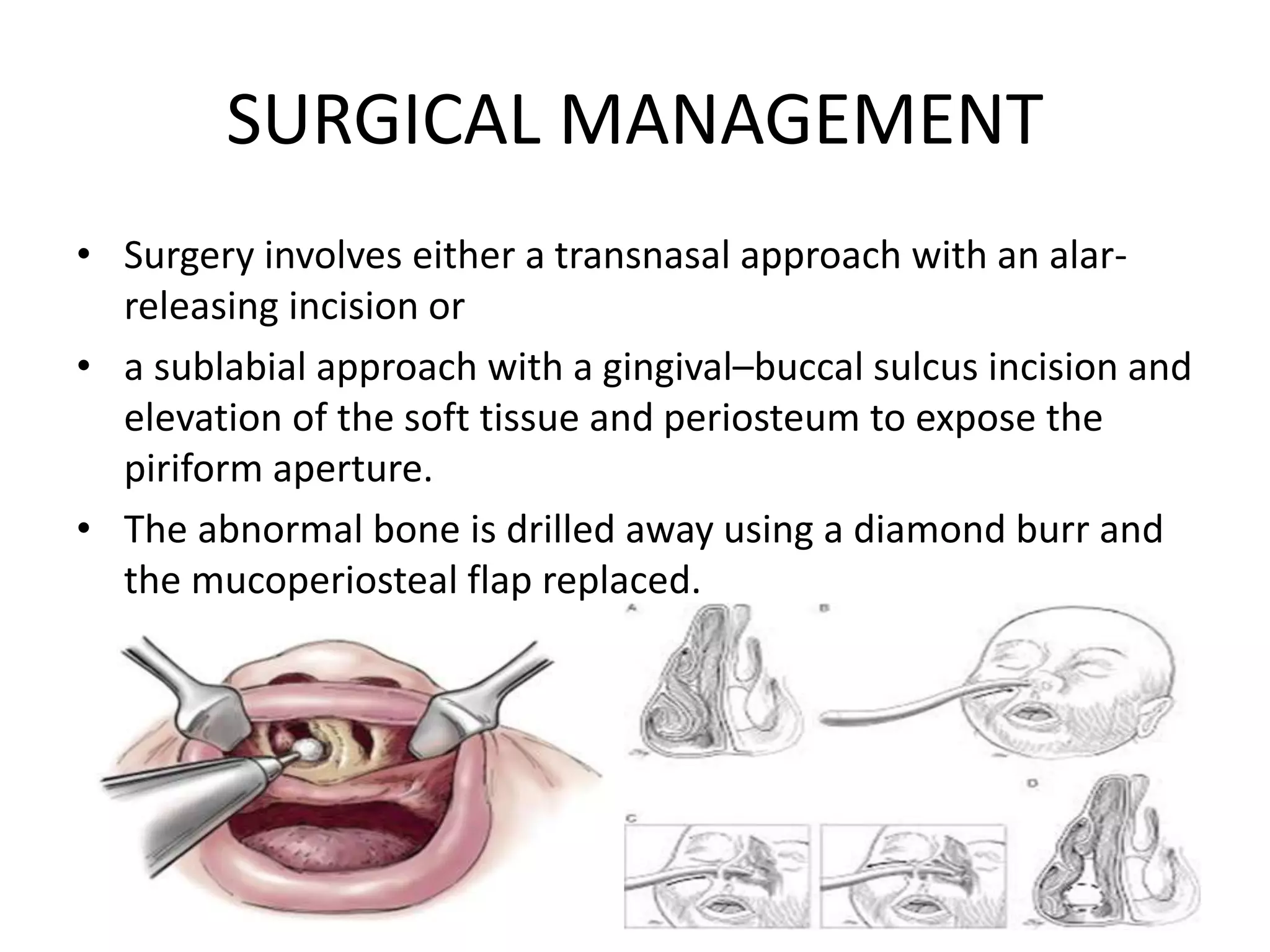 Neonatal nasal obstruction final | PPTX