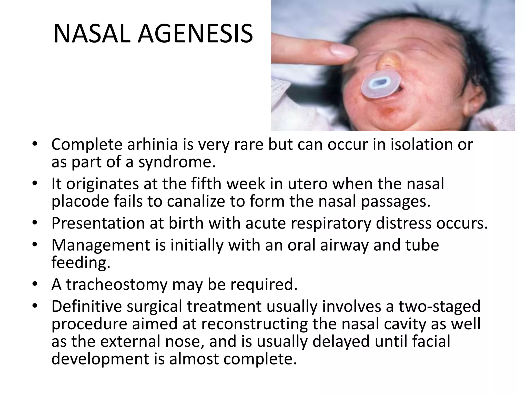 Neonatal nasal obstruction final | PPTX