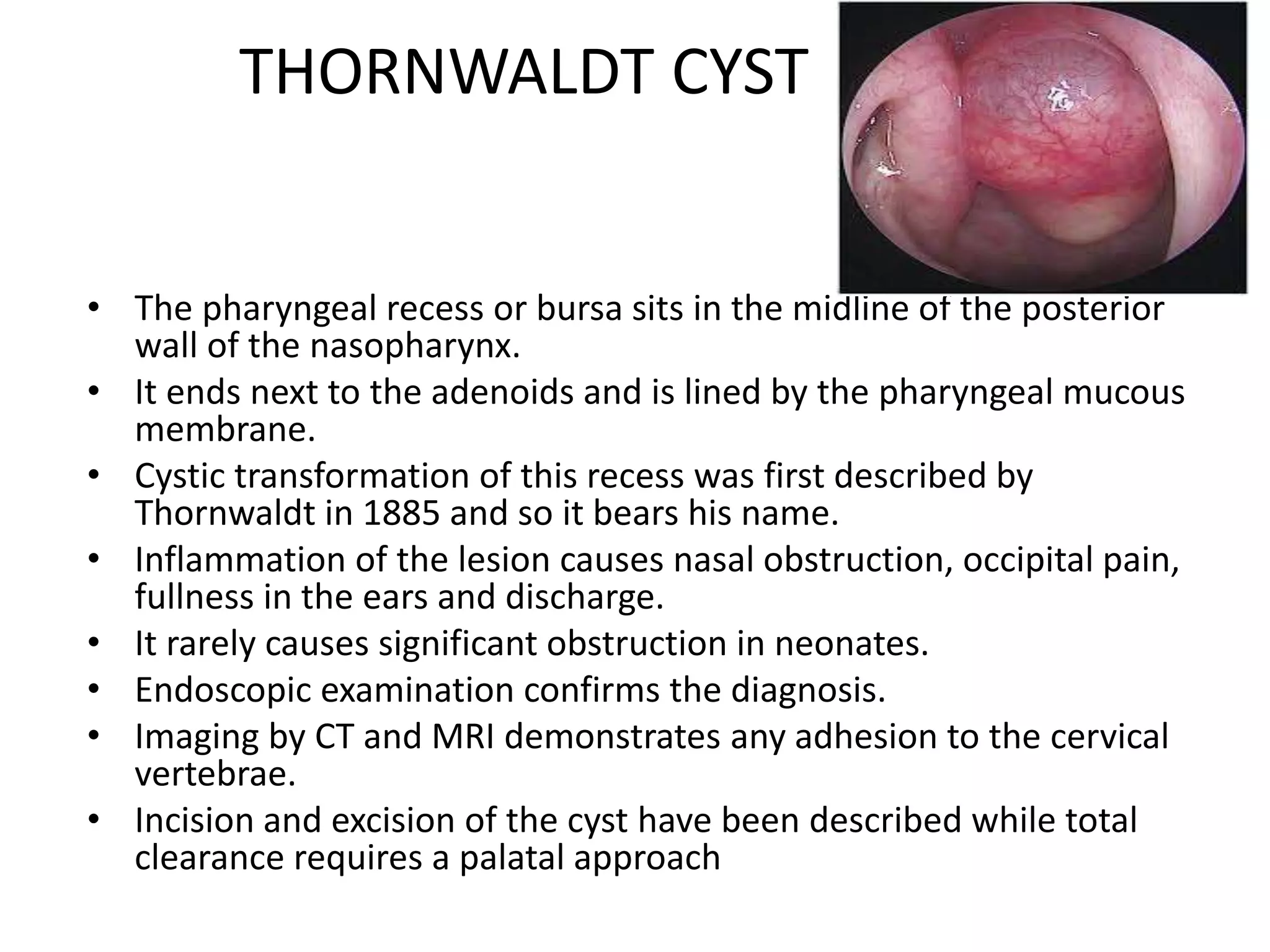 Neonatal nasal obstruction final | PPTX