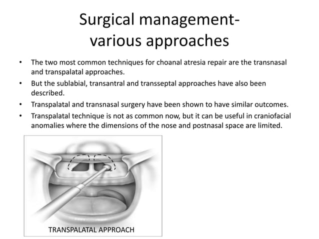 Neonatal nasal obstruction final | PPTX | Ear, Nose and Throat ...