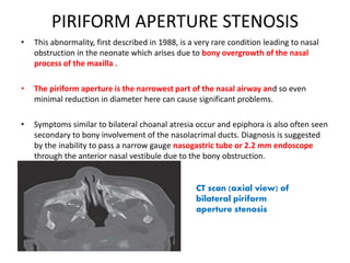 Neonatal nasal obstruction final | PPTX