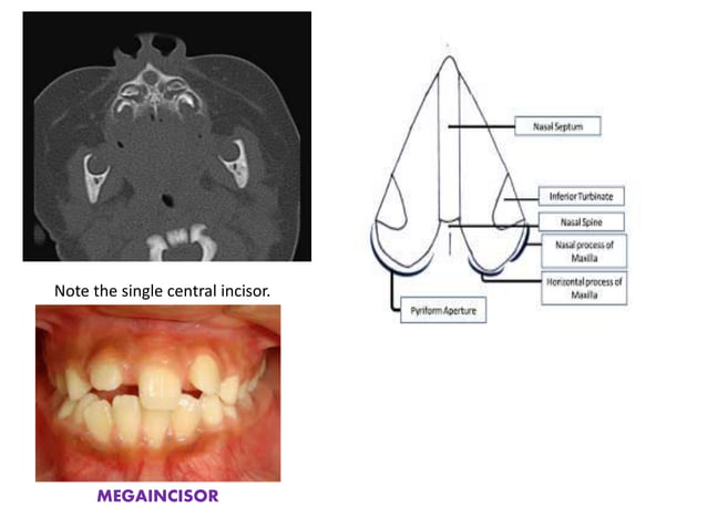 Neonatal nasal obstruction final | PPTX | Ear, Nose and Throat ...