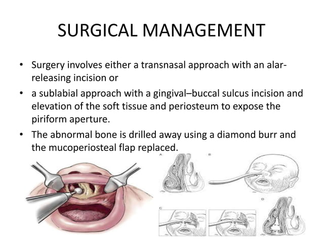 Neonatal nasal obstruction final | PPTX | Ear, Nose and Throat ...