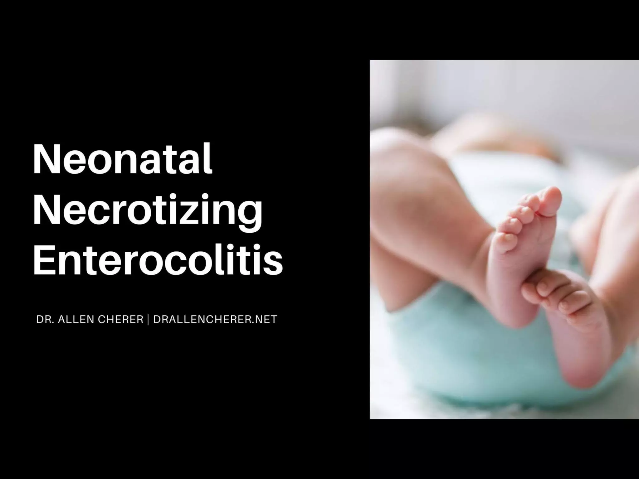 Neonatal Necrotizing Enterocolitis: Overview | PPTX
