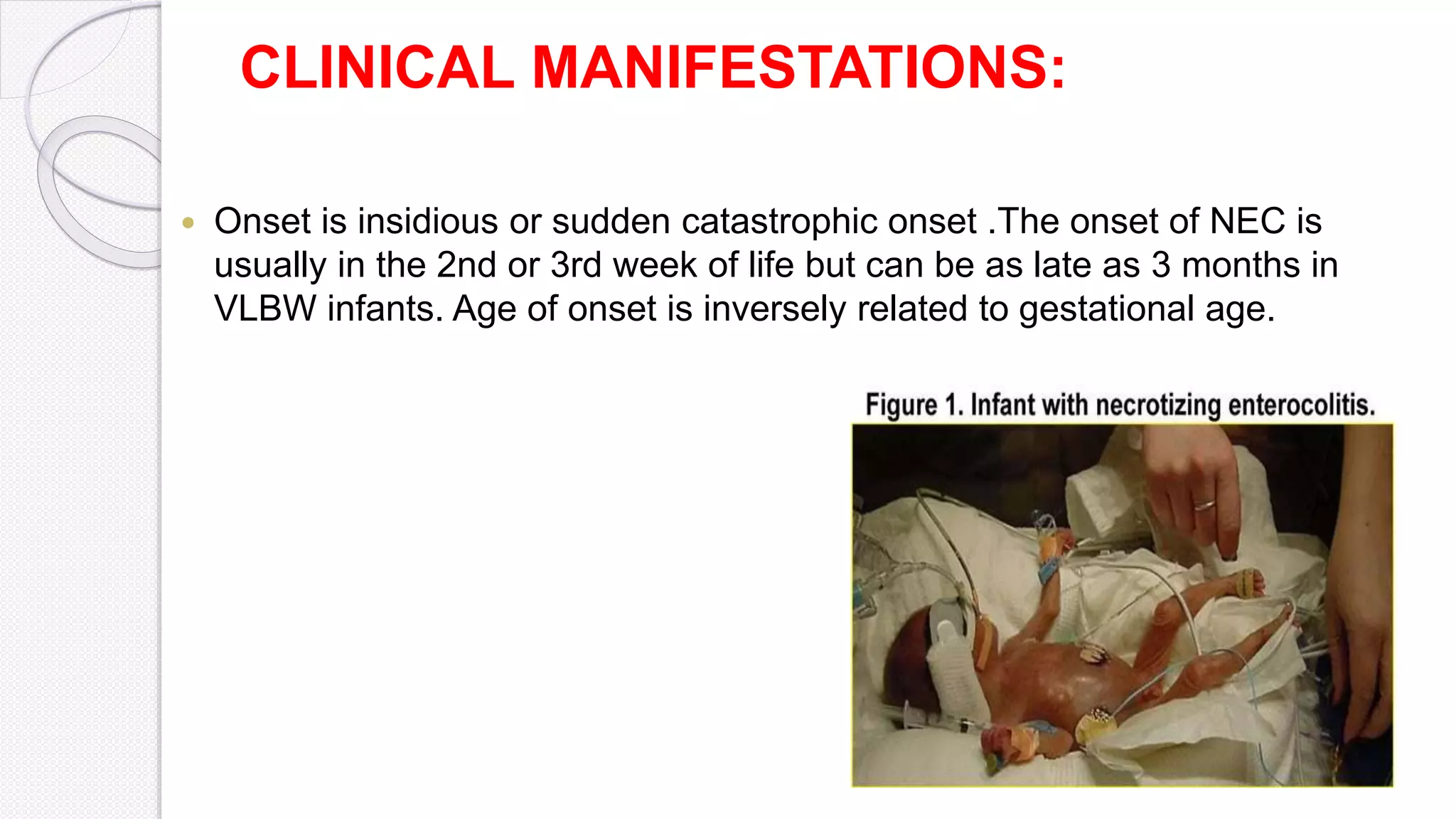 Neonatal Necrotizing Enterocolitis | PPTX