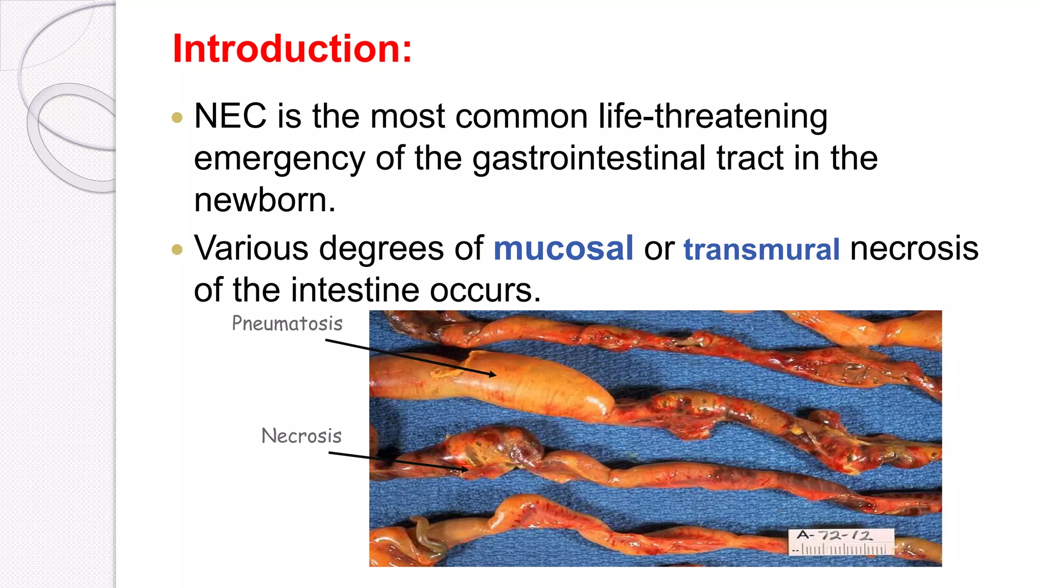 Neonatal Necrotizing Enterocolitis | PPTX