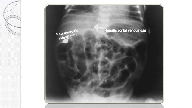 Neonatal Necrotizing Enterocolitis