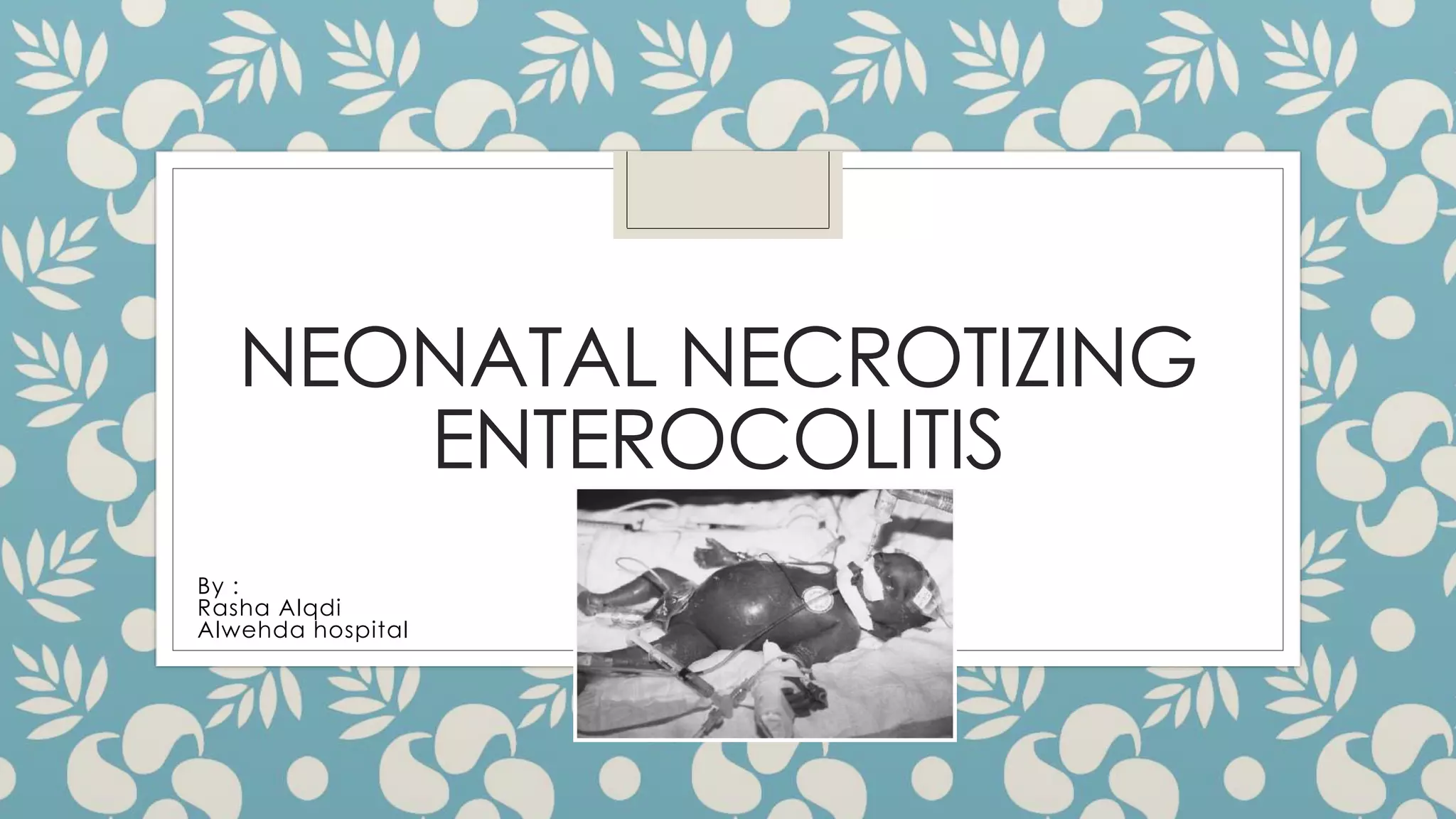 Neonatal necrotizing enterocolitis | PPTX
