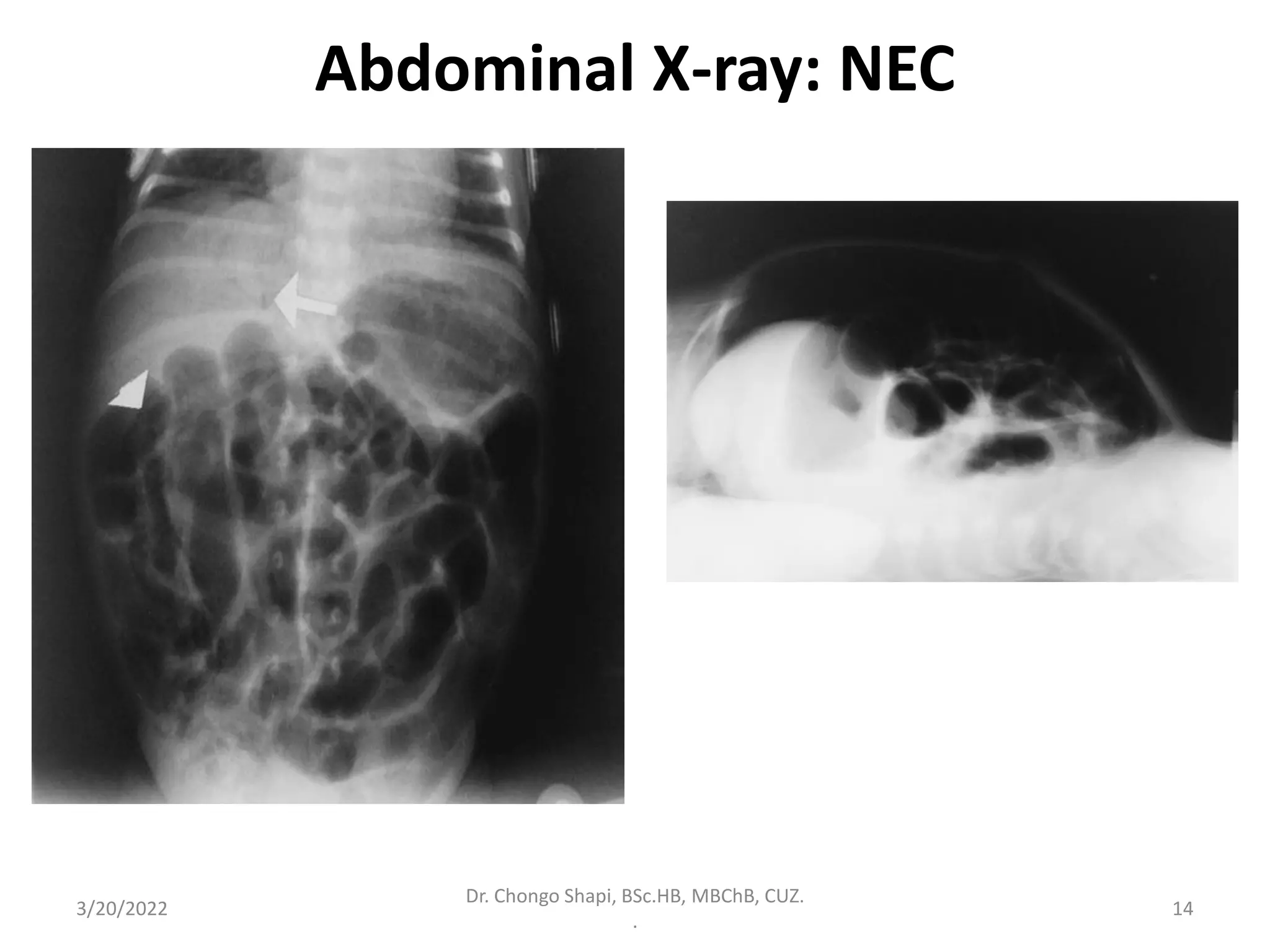 Neonatal Necrotizing Enterocolitis (NEC).pdf