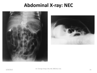 Neonatal Necrotizing Enterocolitis (NEC).pdf