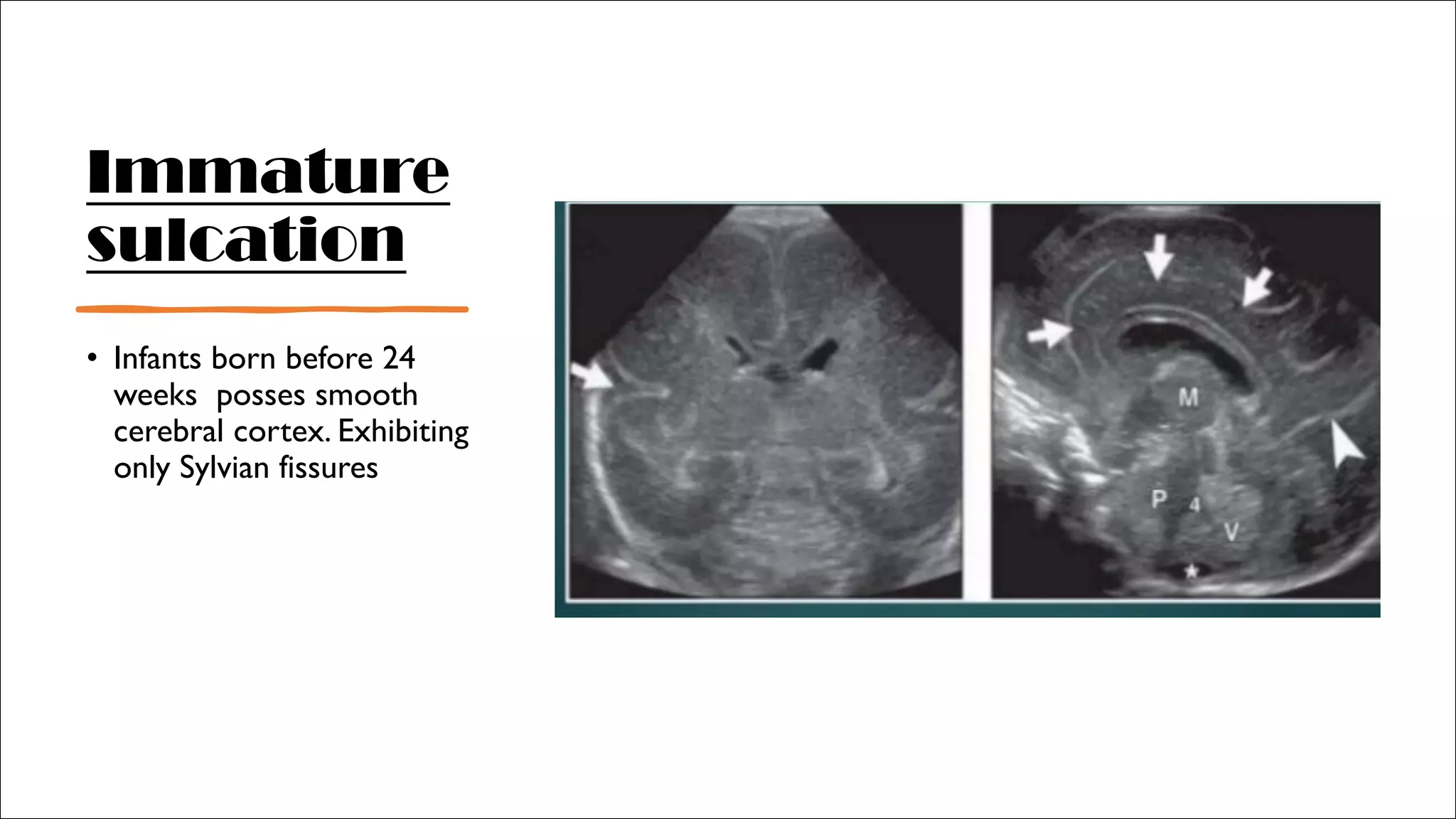 Neonatal neurosonography | PDF