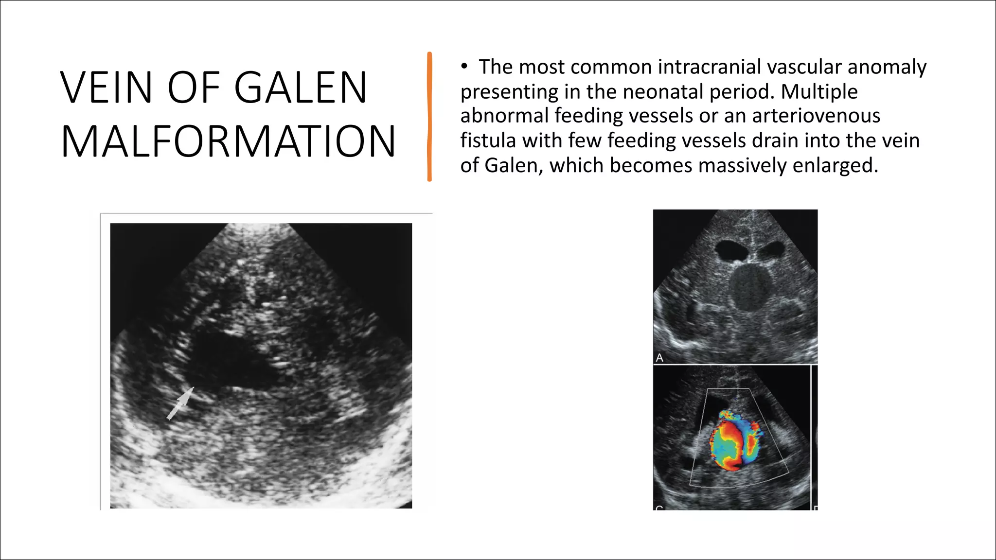 Neonatal neurosonography | PDF