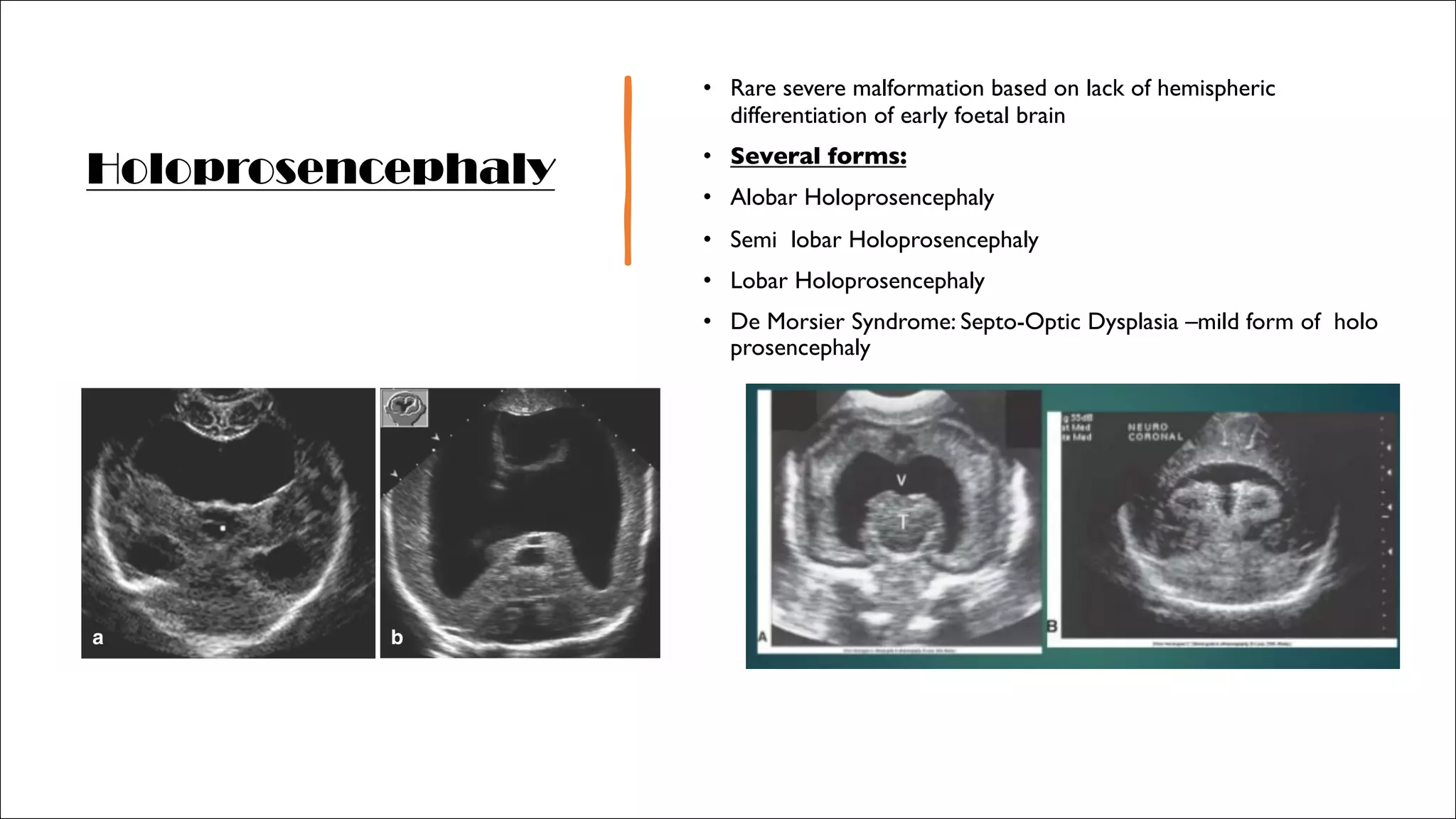 Neonatal neurosonography | PDF