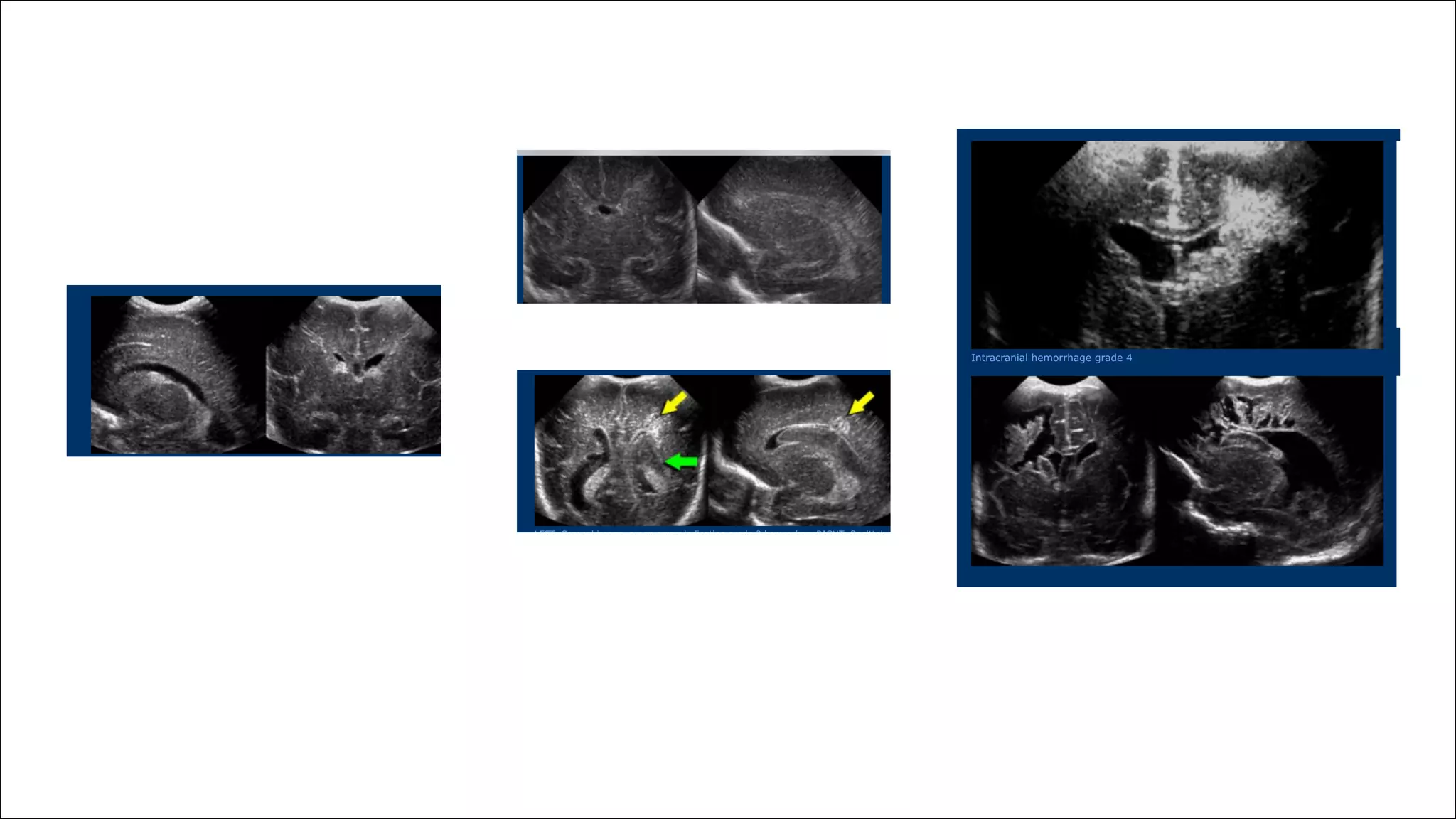 Neonatal neurosonography | PDF