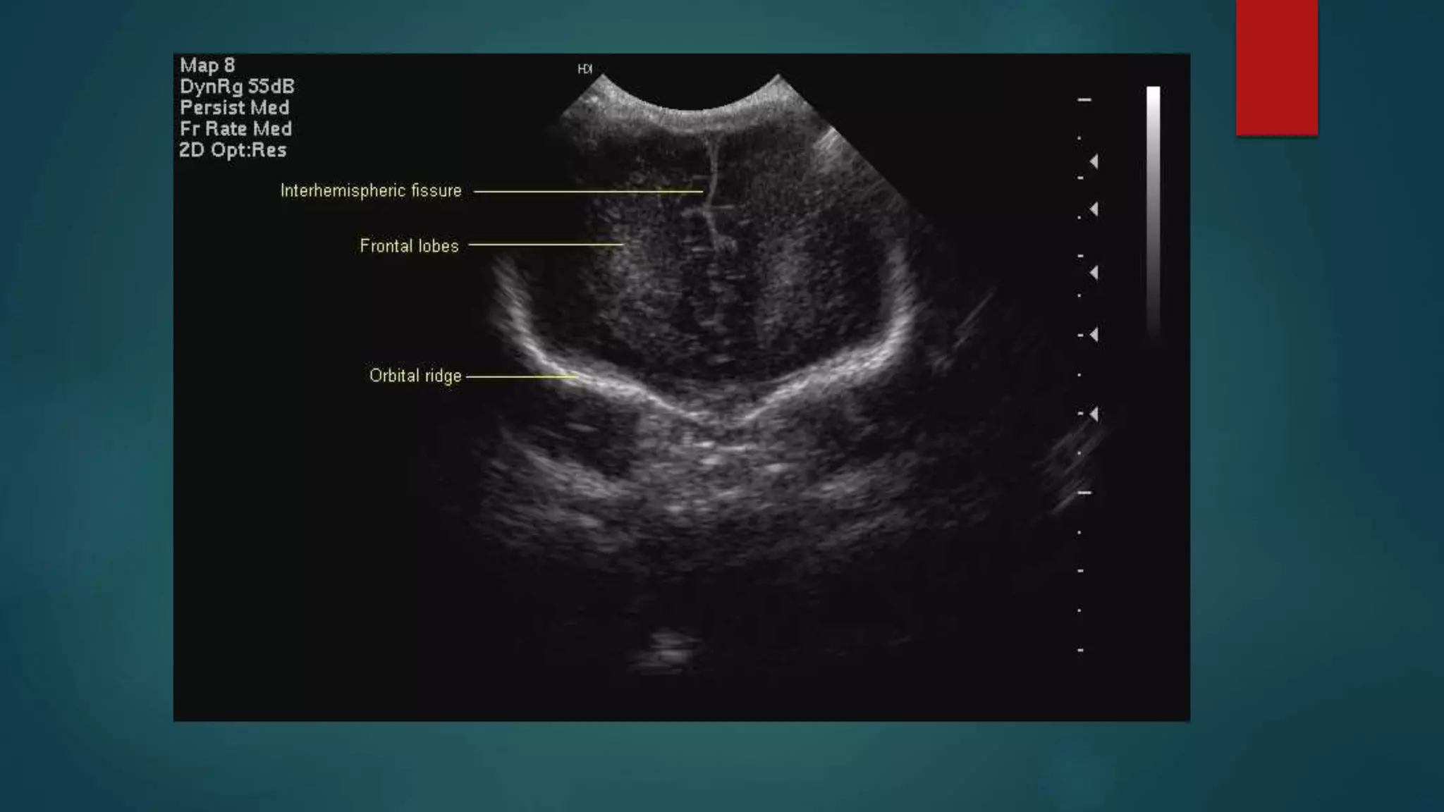Neonatal neurosonography | PPTX