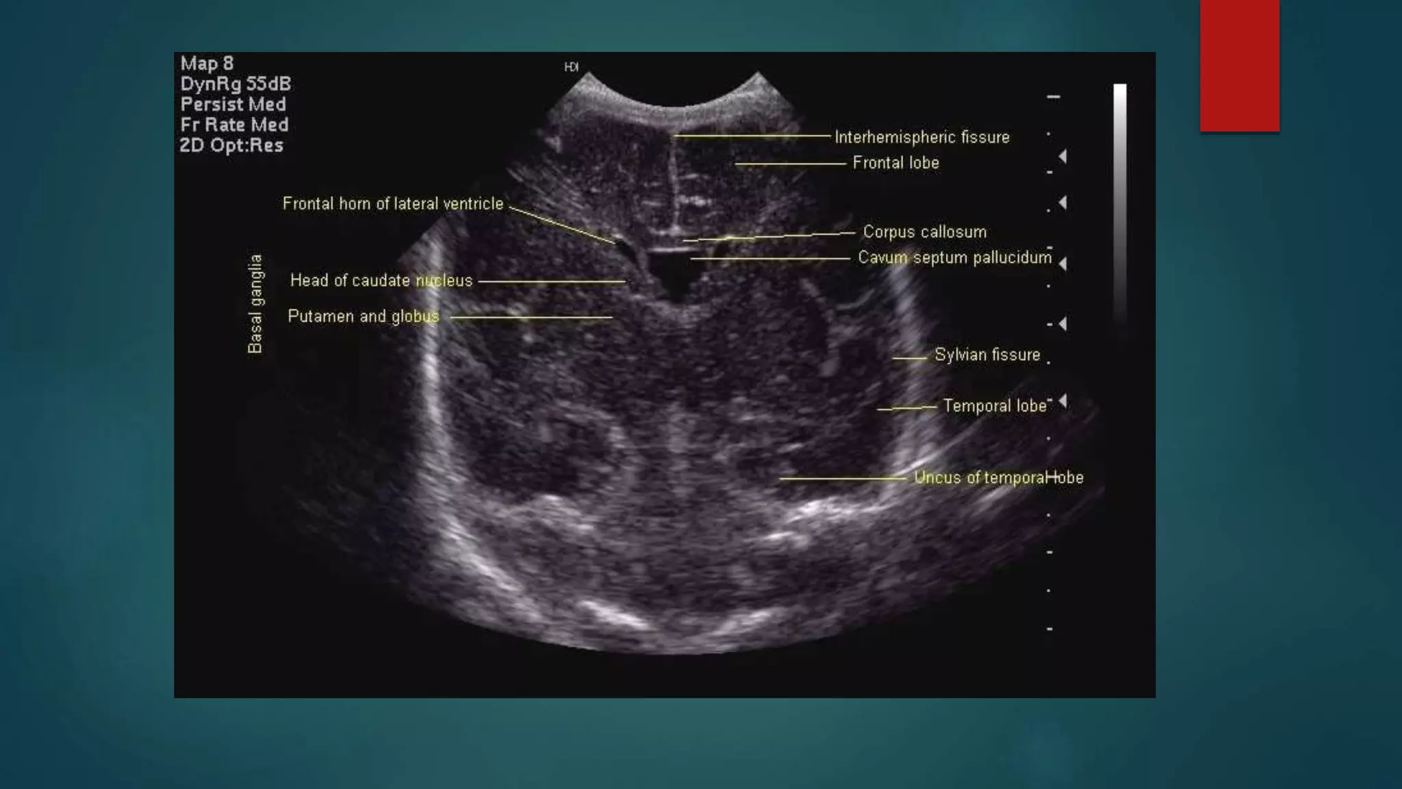 Neonatal neurosonography | PPTX
