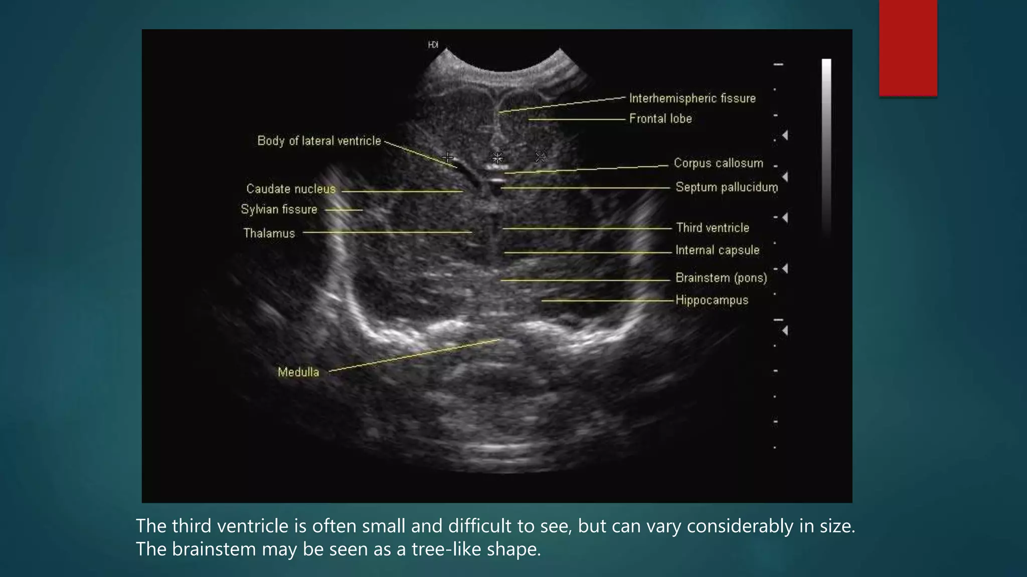 Neonatal neurosonography | PPTX