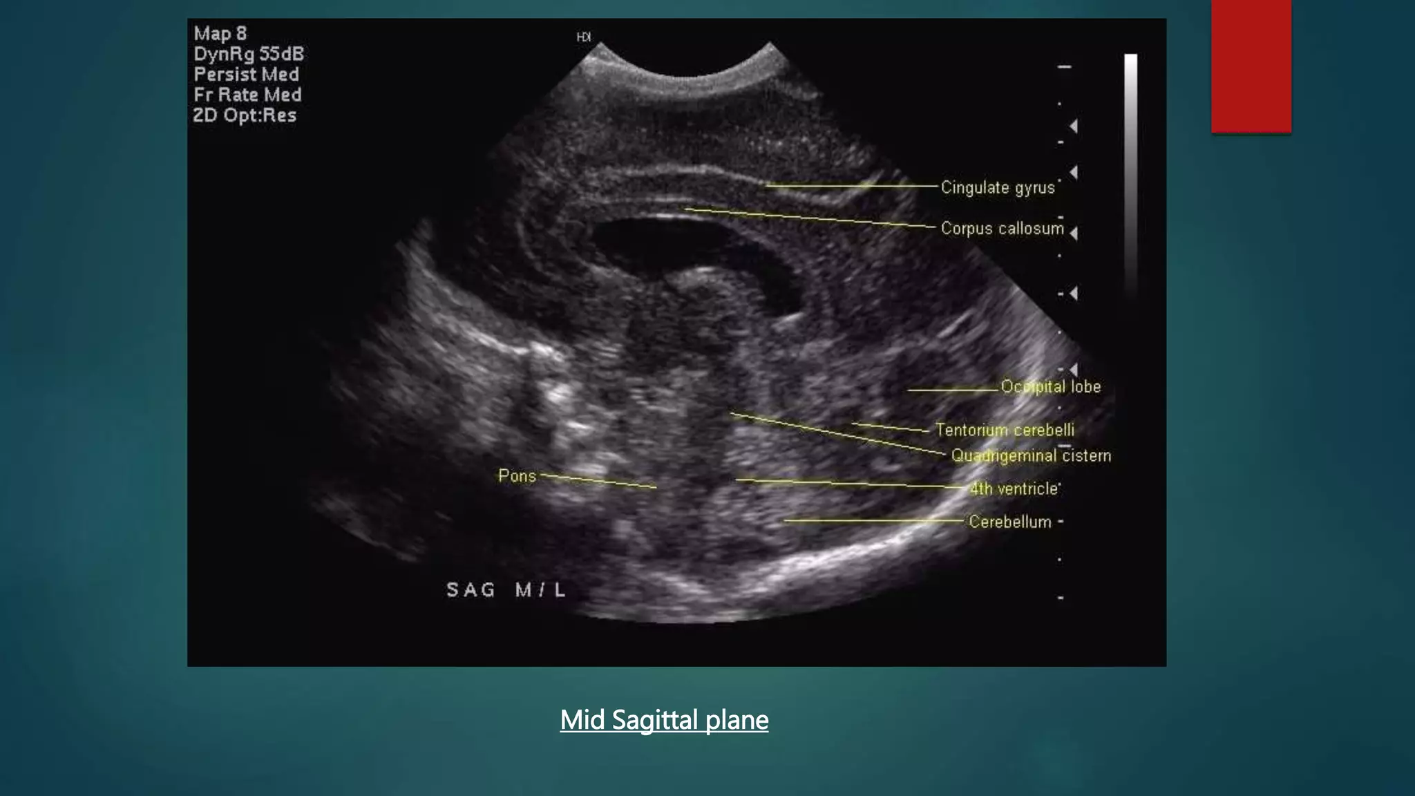 Neonatal neurosonography | PPTX
