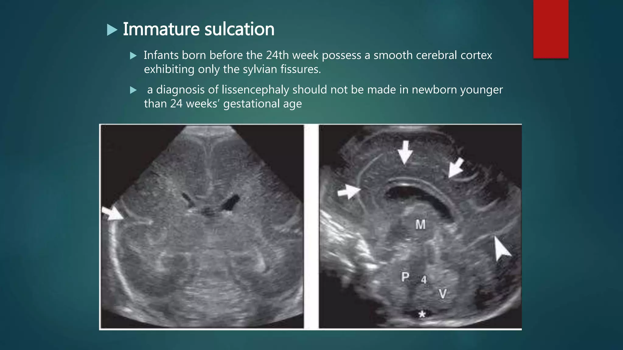 Neonatal neurosonography | PPTX