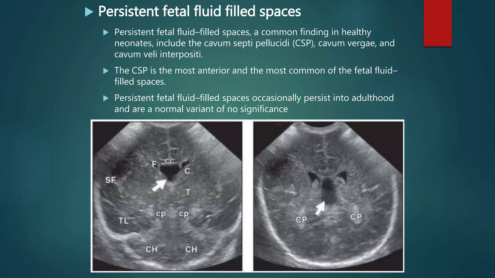 Neonatal neurosonography | PPTX