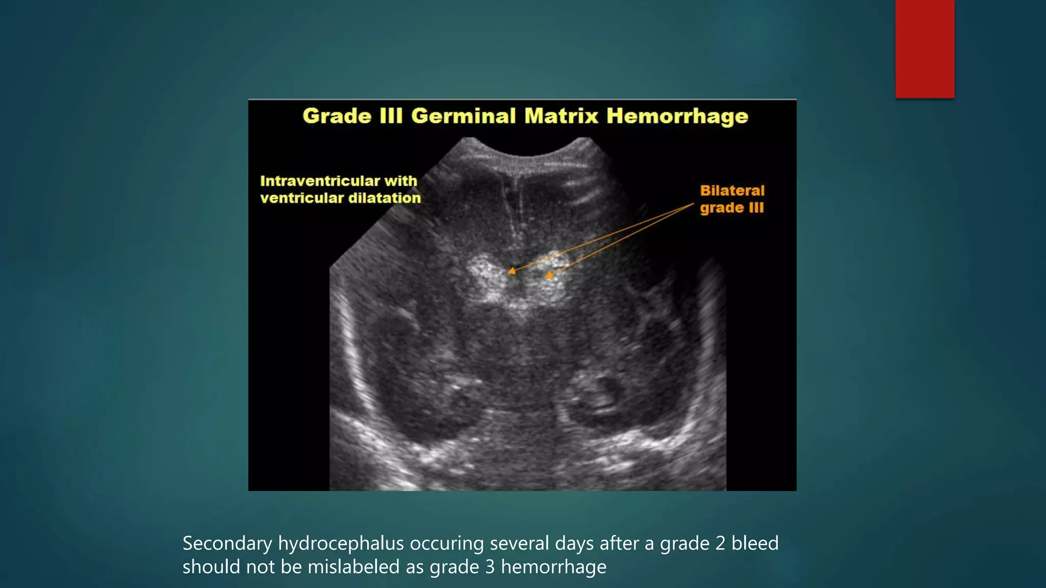 Neonatal neurosonography | PPTX