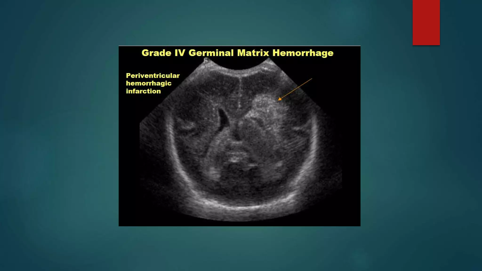 Neonatal neurosonography | PPTX