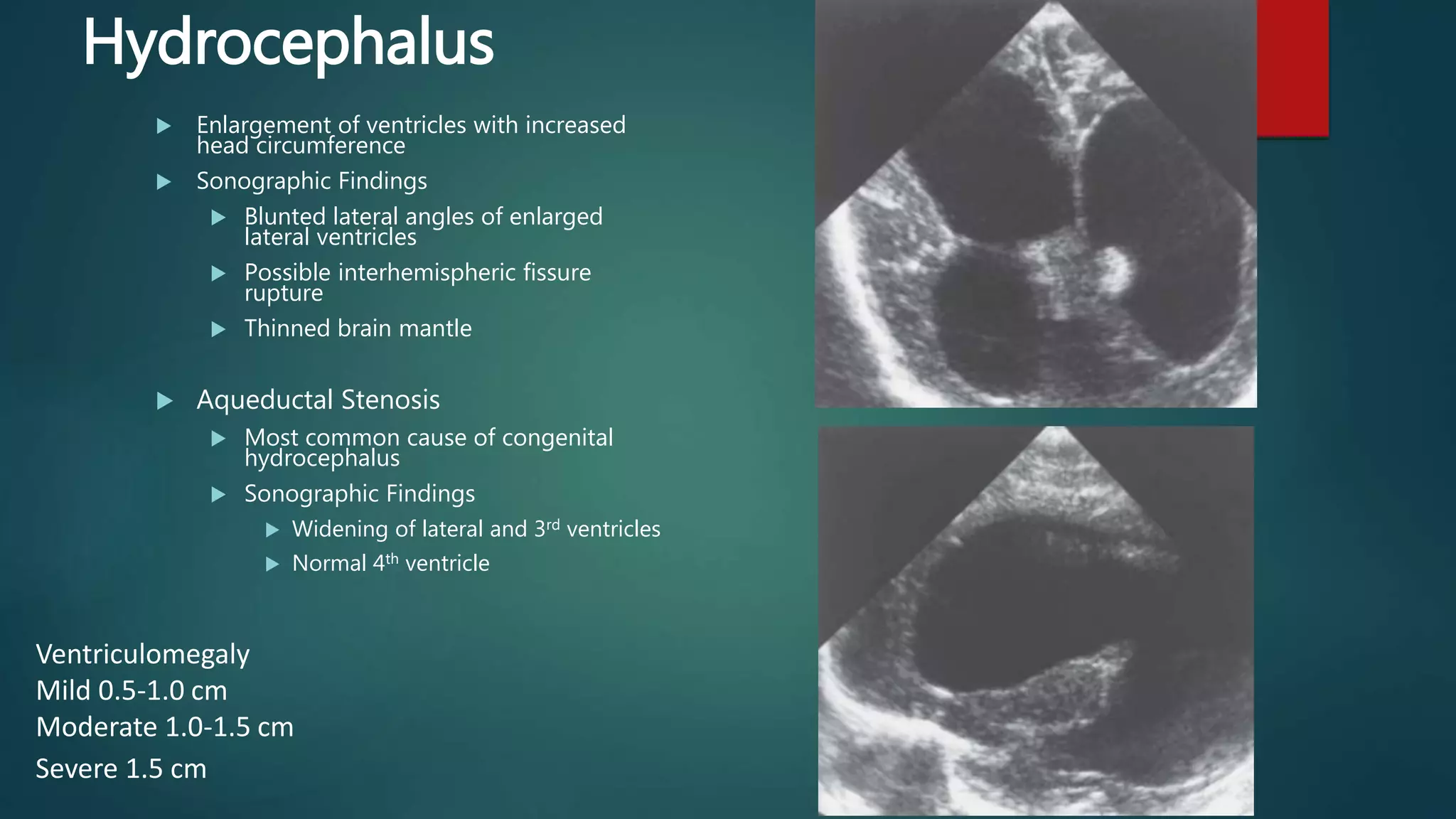 Neonatal neurosonography | PPTX