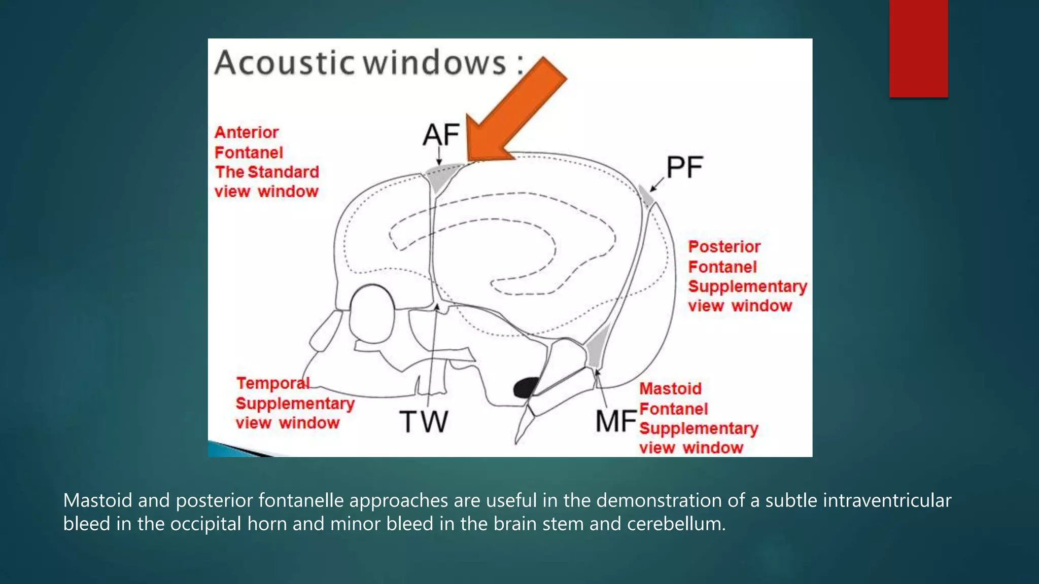 Neonatal neurosonography | PPTX