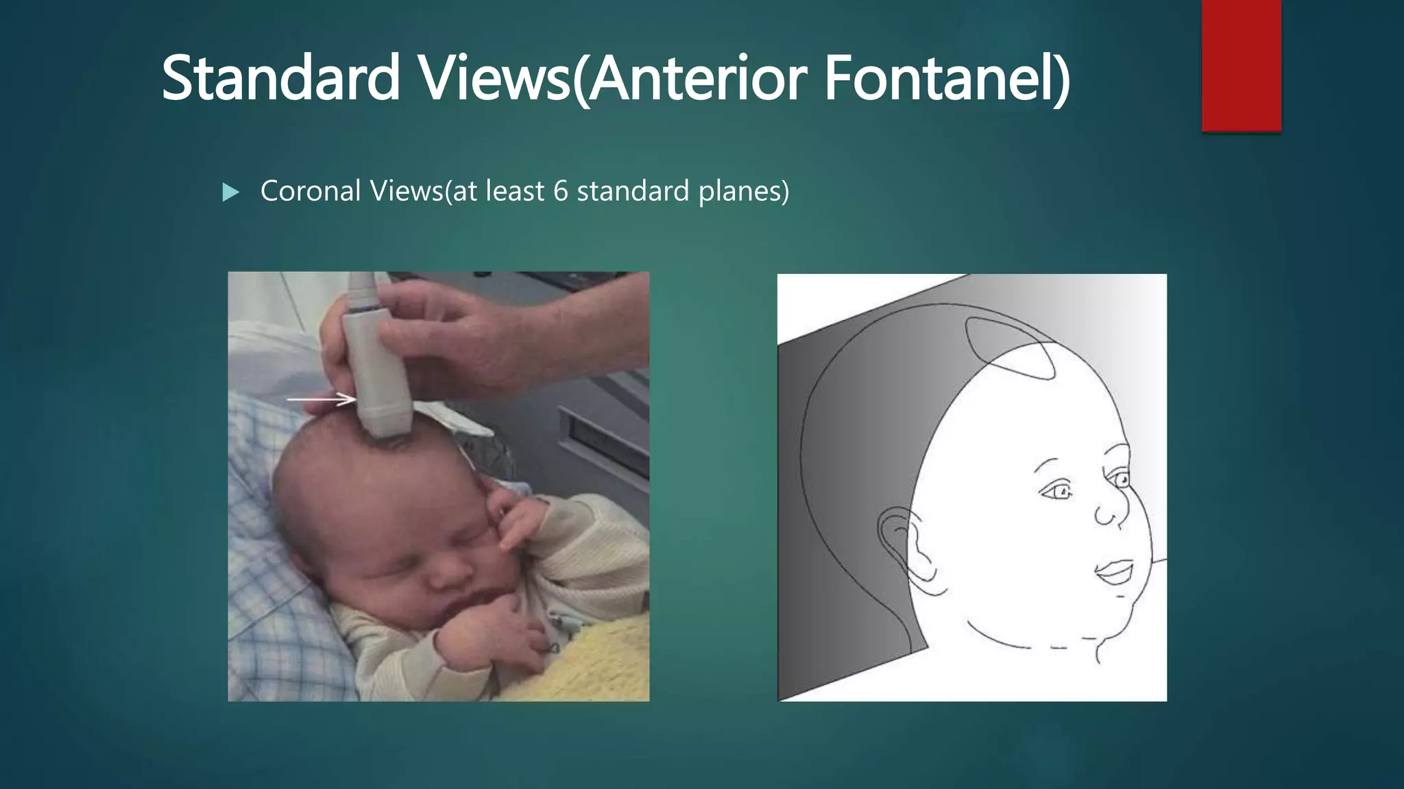 Neonatal neurosonography | PPTX