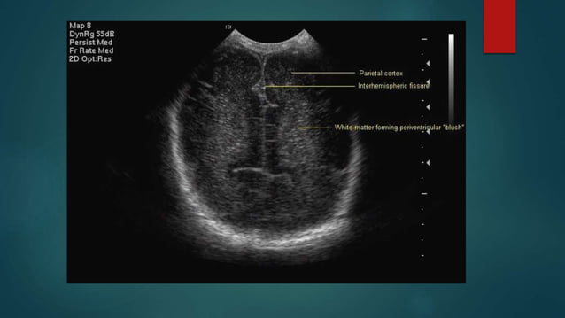 Neonatal neurosonography | PPTX