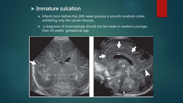 Neonatal neurosonography | PPTX