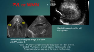 Neonatal neurosonography | PPTX