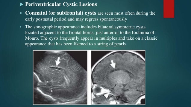 Neonatal neurosonography