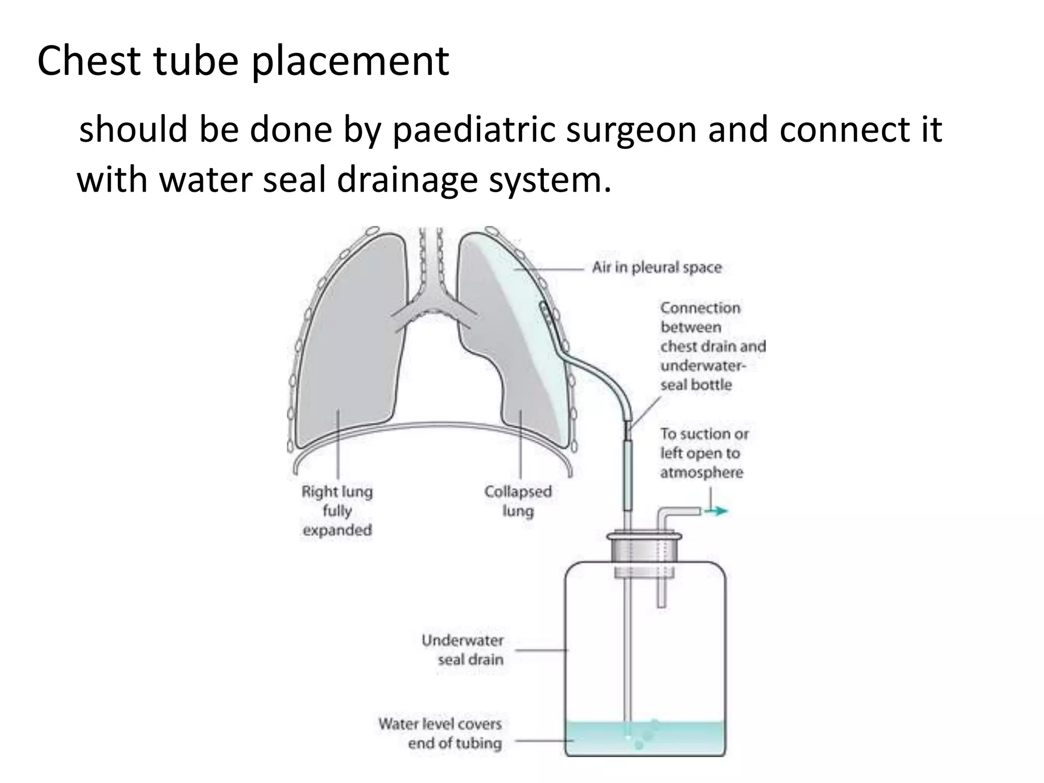 Neonatal pneumothorax | PPTX
