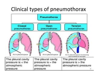 Neonatal pneumothorax | PPT