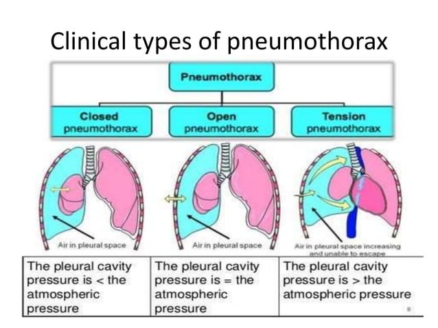 Neonatal pneumothorax